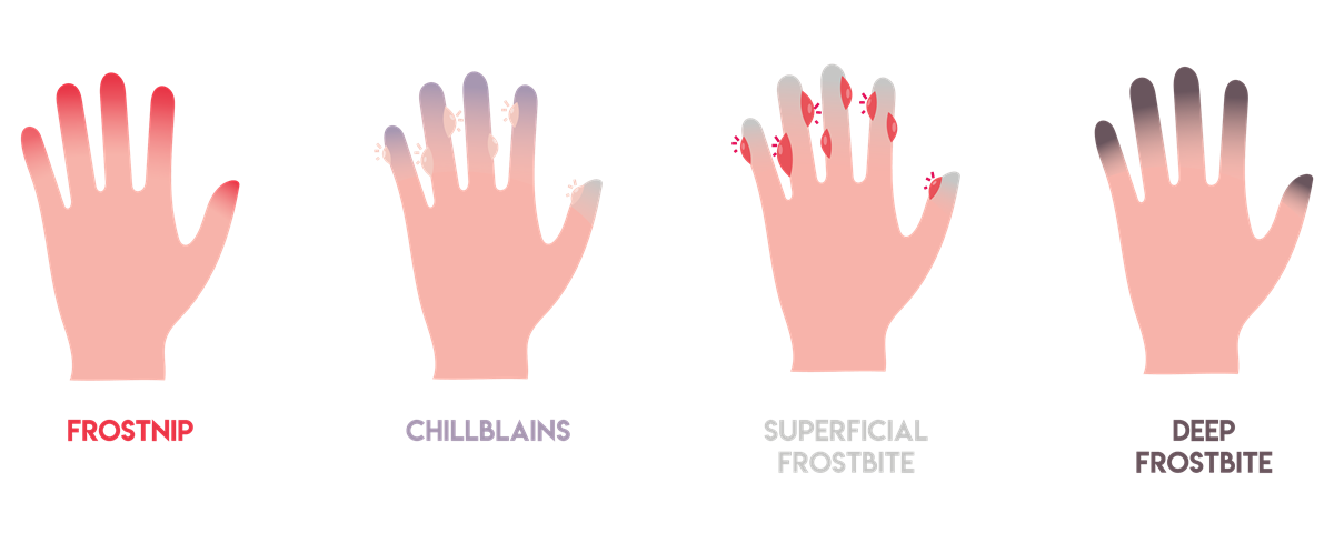 Frostbite Meaning Out Of The Cold: Management Of Hypothermia And